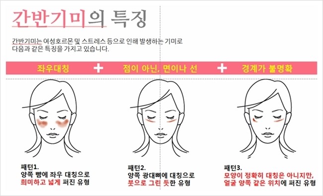 기미화장품으로 유명한 트란시노 화이트닝 에센스~ 기미없애는방법 네이버 블로그