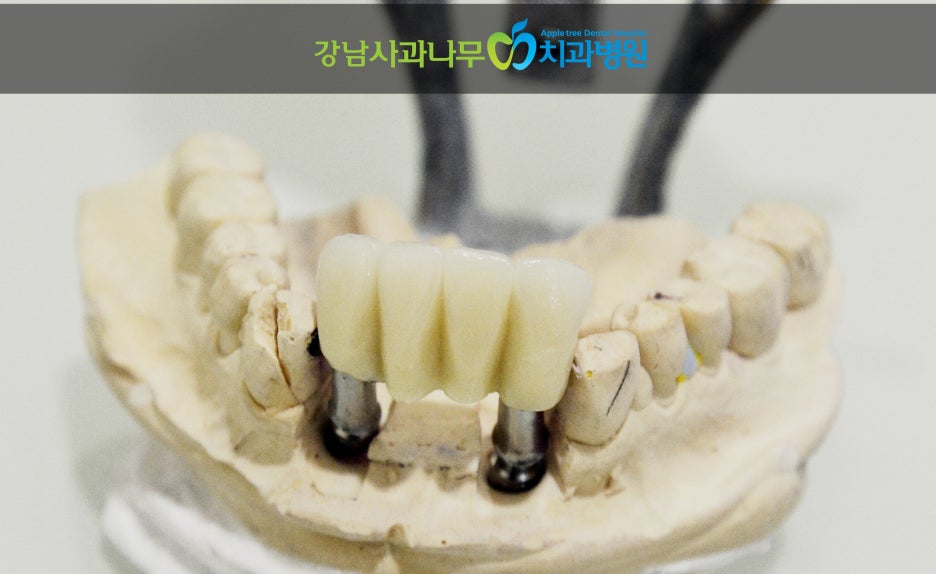 치아브릿지 수명and교체 가격에 대해 알려드리겠습니다 네이버 블로그