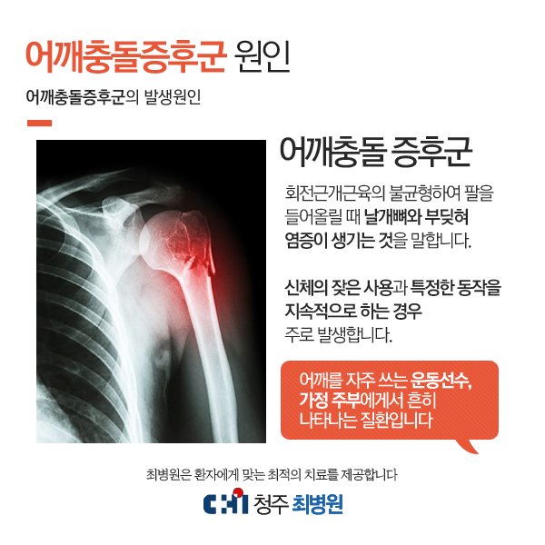 어깨통증 어깨충돌증후군의 원인과 증상 자가진단까지 네이버 블로그