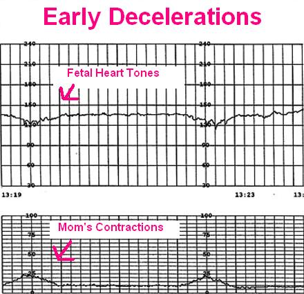 조기하강 early deceleration& 후기하강 late deceleration &가변성 하강variable ...