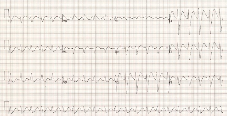 TCA overdose, ECG : 네이버 블로그