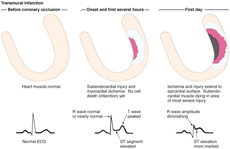 NSTEMI vs. STEMI : 네이버 블로그