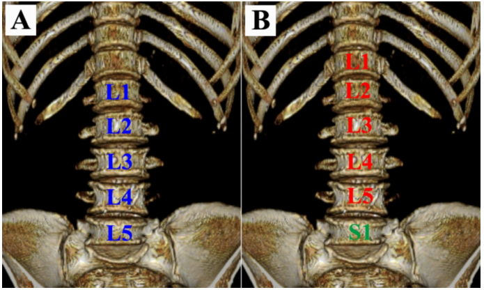 lumbosacral transitional vertebrae (LSTV: lumbarization and ...