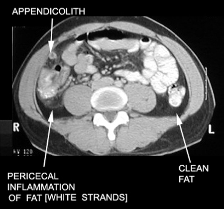 Appendicitis CT 소견 : 네이버 블로그