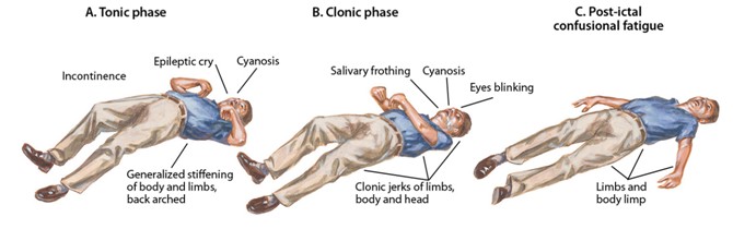 Neurologic Emergency (seizure) : 네이버 블로그