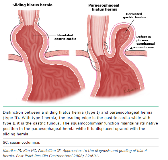 식도 열공 헤르니아, Esophageal hiatus hernia : 네이버 블로그